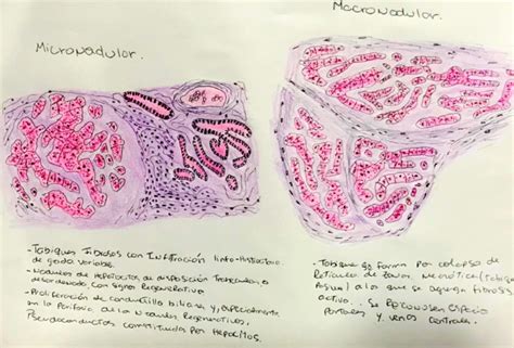 Cirrosis Micro Y Macronodular Pdf
