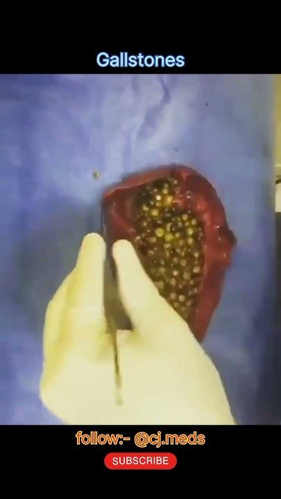 Gallbladder Stones Gallbladder Dissection Laparoscopic
