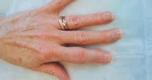 Psoriatic Arthritis Symptoms And Treatment The Hand Society
