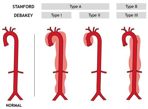 Aortic Dissection Causes Symptoms And Treatment Medcrine