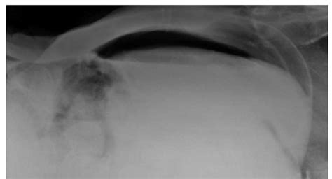 Figure 3 From Spectrum Of Signs Of Pneumoperitoneum