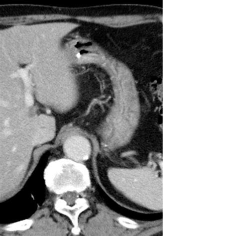 Endoscopic Findings A Duodenal Polyp 2 Cm On The Bulb Portion With A Download Scientific