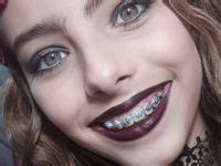 7 Idées De Lappareil Dentaire Appareil Dentaire Dentaire Orthodontie