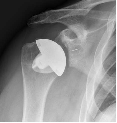 Patients Guide To Total Shoulder Replacement Arthroplasty