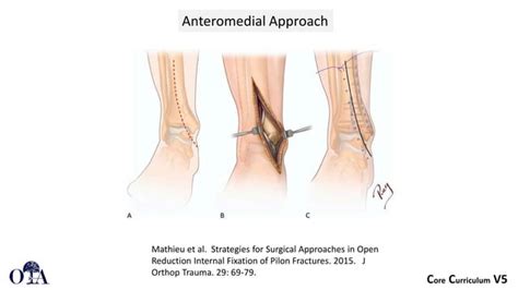 Pilon Fractures Definition And Classification Pdf