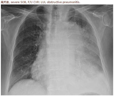 醫學記事 105 09 27 [影像醫學] Chest Obstructive Pneumonitis