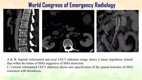 Spontaneous Sma Dissection An Unusual Cause Of Intestinal Obstruction