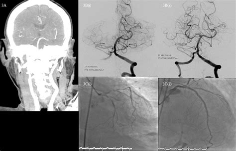 A Ct Angiogram Showing Thrombus In The P1 Segment B Cerebral Angiogram