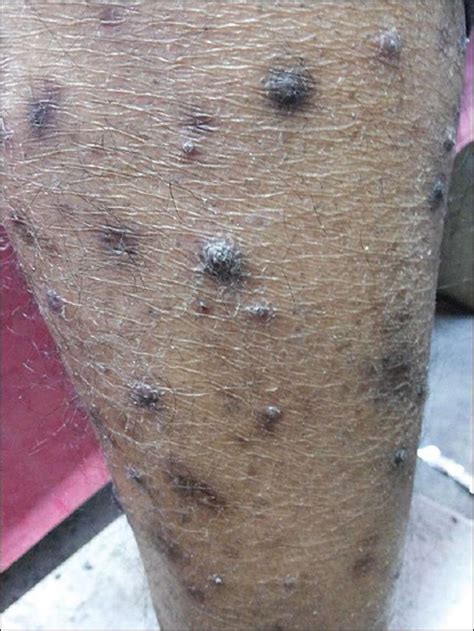 Types Déruptions Cutanées Liées Au Vih Fmedic