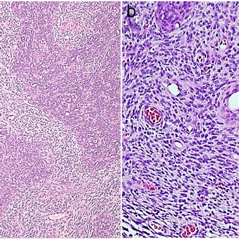 Histologically The Tumor Displays A Biphasic Growth Pattern In Which