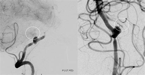Vertebral Pseudoaneurysm Unruptured Pipeline