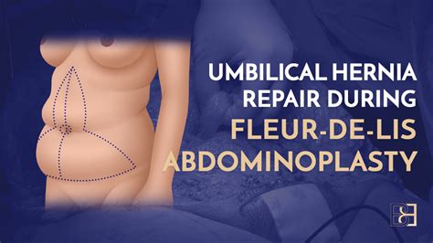 Dr Bbs Guide To Belly Button Umbilicus Beautification And