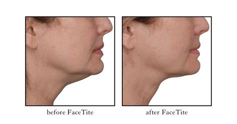 Facetite Jawline Sculpting And Double Chin Reduction Cslc