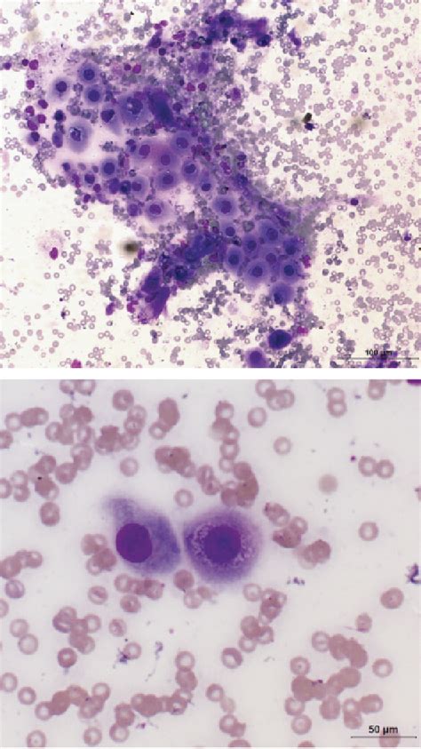 Hyperalbuminemia Semantic Scholar