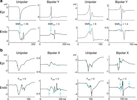 Bipolar Vs Unipolar Electrodes At Edward Oneal Blog