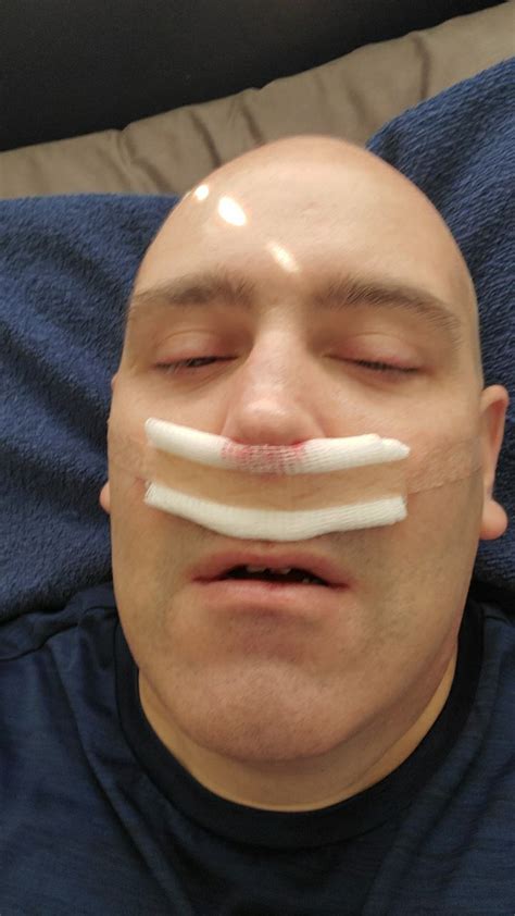 Second Revision Rsinusitis