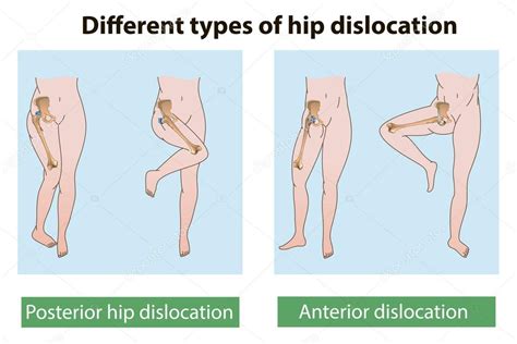 Hip Dislocation Stock Vector Image By ©maryna Melnyk 71821565