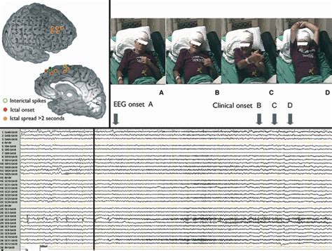 Left Upper Insert Position Of Subdural Grid Contacts Projected Onto Download Scientific