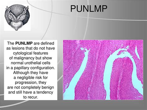 Ppt Bladder Cancer Powerpoint Presentation Free Download Id 3626835