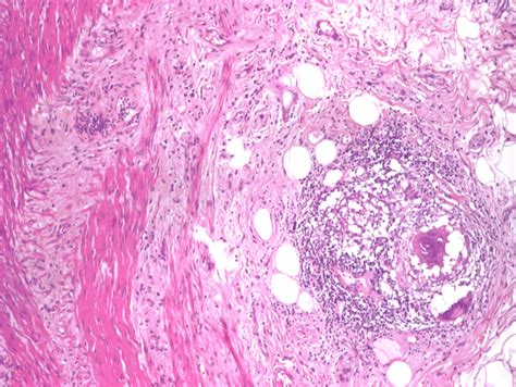 Microscopic Image Of Appendicular Mucosa In Which One Can Observe The Download Scientific