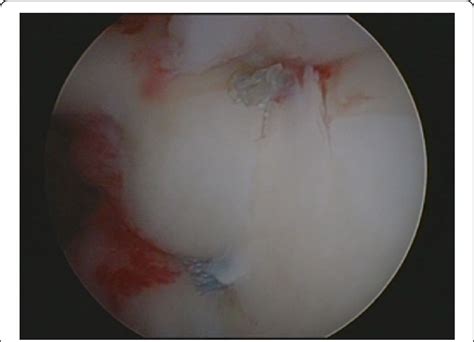 Restored Labral Complex Download Scientific Diagram