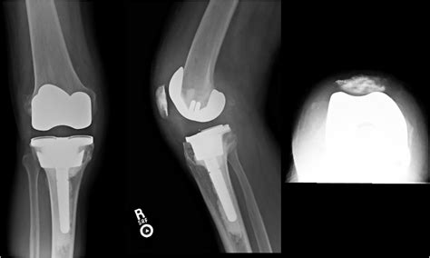 Tibial Osteolysis After Long Term Isolated Polyethylene Patellar