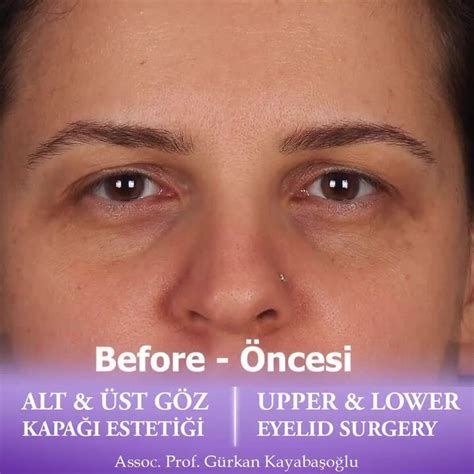 Double Blepharoplasty Video Realself