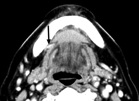 Imaging Of The Mylohyoid Muscle Separation Of Submandibular And