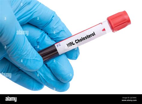 Hdl Cholesterol Medical Check Up Test Tube With Biological Sample Stock