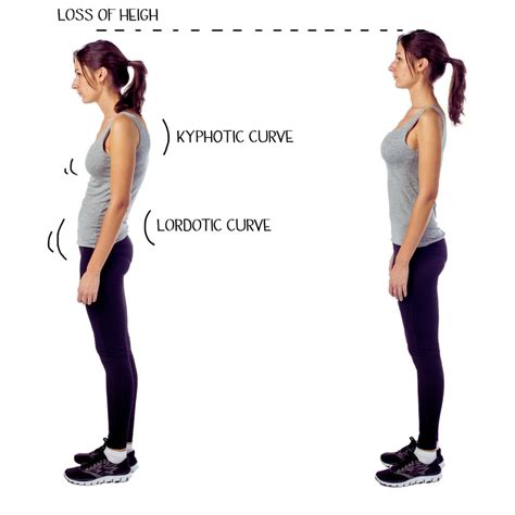 Get 33 Kyphosis Lordosis Posture Smartofpedia Kyphosis