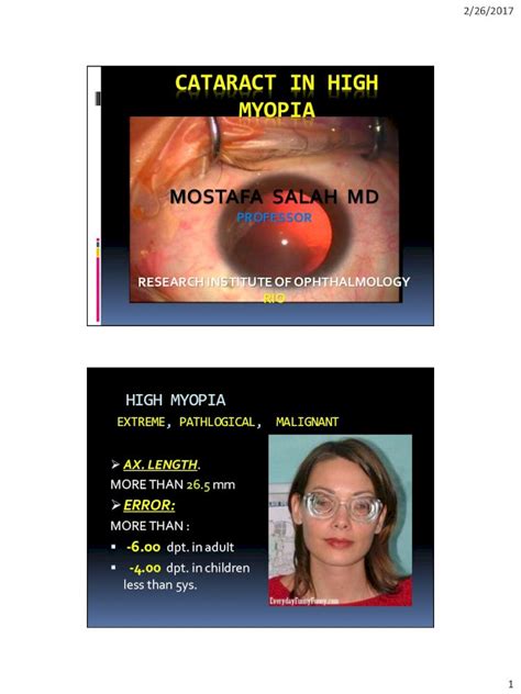 Pdf Cataract In High Myopia · Holladay 2 Needs Wtw Diameter