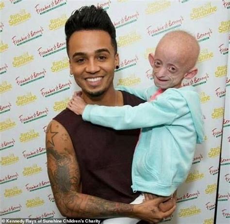 Photos Benjamin Button Disease Teenager With 144 Year Old Body Dies After 18th Birthday Home