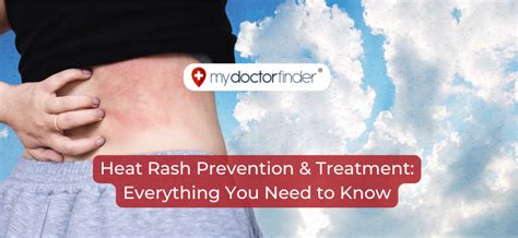 Heat Rash Prevention And Treatment Everything You Need To Know