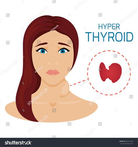 Woman Hyperthyroid Gland Hyperthyroidism Symbol Enlarged Stock