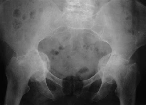 Imaging Of The Hip In Patients With Rheumatic Disorders European