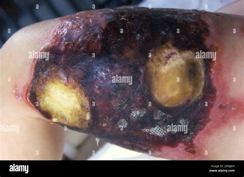 Leg Ulcers Caused By Pyoderma Gangrenosum A Rare Skin Condition This