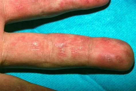 Systemic Lupus Erythematosus Sle Systemic Lupus Erythematosus Sle