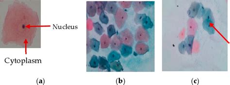 Figure 1 From Computer Assisted Screening For Cervical Cancer Using Digital Image Processing Of