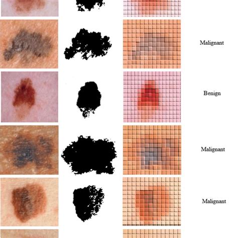 The Experimental Results Of The Suggested Model Using Isic Datasets Download Scientific Diagram