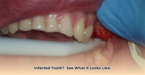 Infected Tooth Extraction Images What To Look For And When To Seek Help