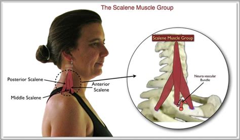 The Scalene Trigger Points Upper Body Troublemakers