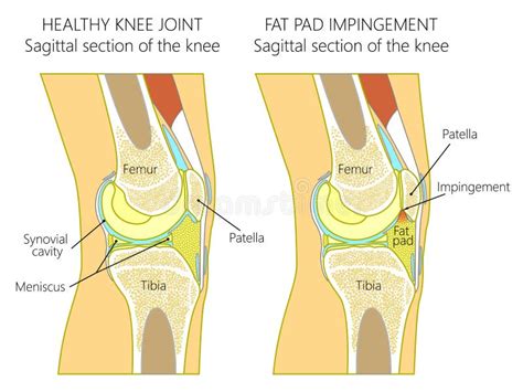 Anatomy Of The Knee Fat Pad Impingement Due To Hyperextension Stock