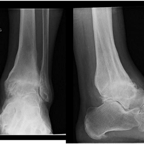 Plain Films Of The Patients Left Ankle Prior To Intervention
