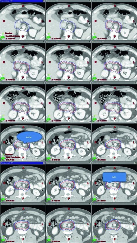 Testicular Seminoma Field Setup And Planning Rt Medical Systems