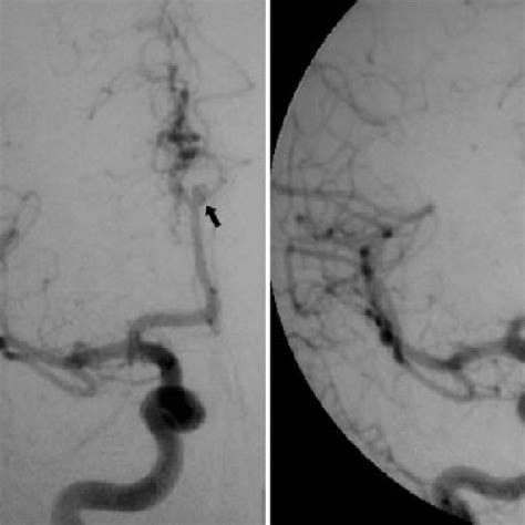Cognard Classification Of Dural Arteriovenous Fistulas Download Table