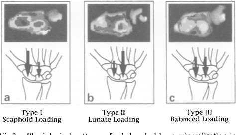 Figure 1 From Altered Patterns Of Subchondral Bone Mineralization In