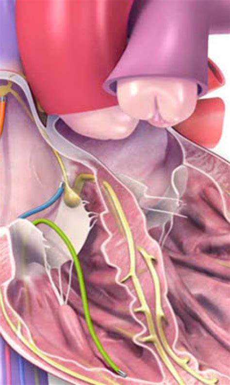 Catheter Ablation Arrhythmia At Dr Karthigesan Clinic