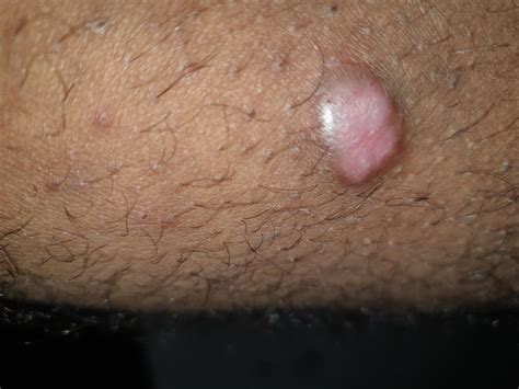 Giant Pimple Looking Thing Inner Thigh Rdermatologyquestions