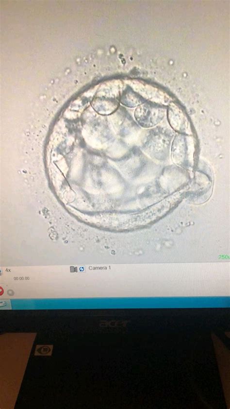 Blastocyst Hatching Vitrolife Irbid Specialty Hospital مستشفى اربد التخصصي Yasmina Hamdan