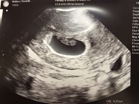Ultrasound Pictures Of Twins At 7 Weeks At Glenn Ross Blog
